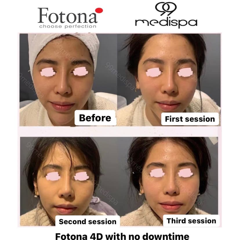 Fotona VectorLift | Non-Invasive Eyebrow Lifting & Upper Eyelid ...